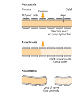 Surgical Wounds: A Guide to Classification (The Altemeier System)